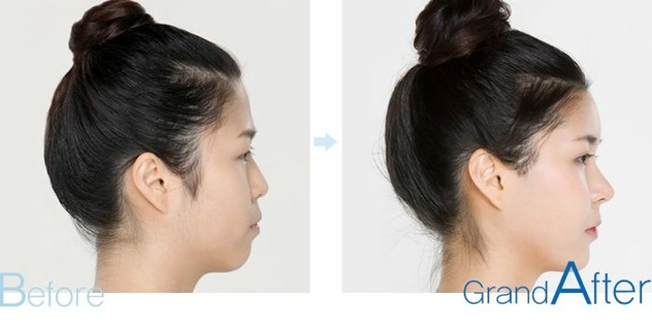 7 Area Wajah yang Sering Jadi Sasaran Prosedur Operasi Plastik