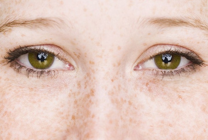 Terdapat Dua Jenis Freckles