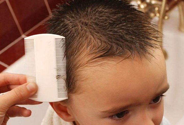Rajin Gunakan Sisir Serit Untuk Membasmi Kutu Rambut Secara Alami