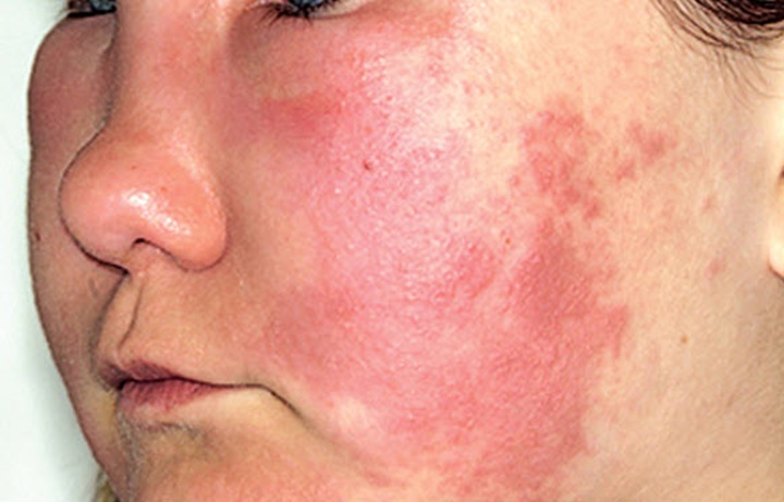 Sebabkan Kulit Terbakar Dan Iritasi