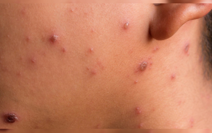 Waspadai Ruam Gatal Seperti Cacar Air! Bisa Jadi Tanda Infeksi Virus Corona