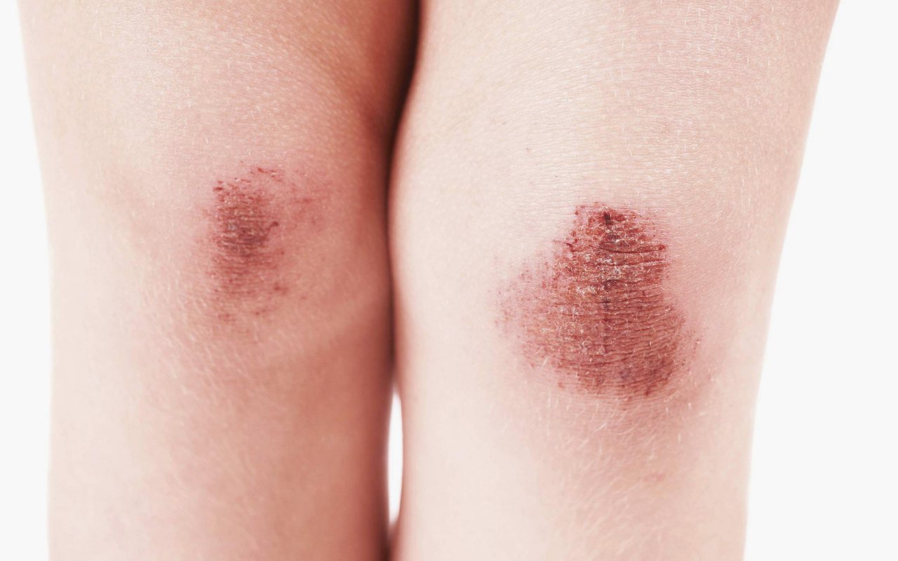 7 Tips Perawatan Untuk Luka Lecet Agar Cepat Sembuh, Baiknya Ditutup ...