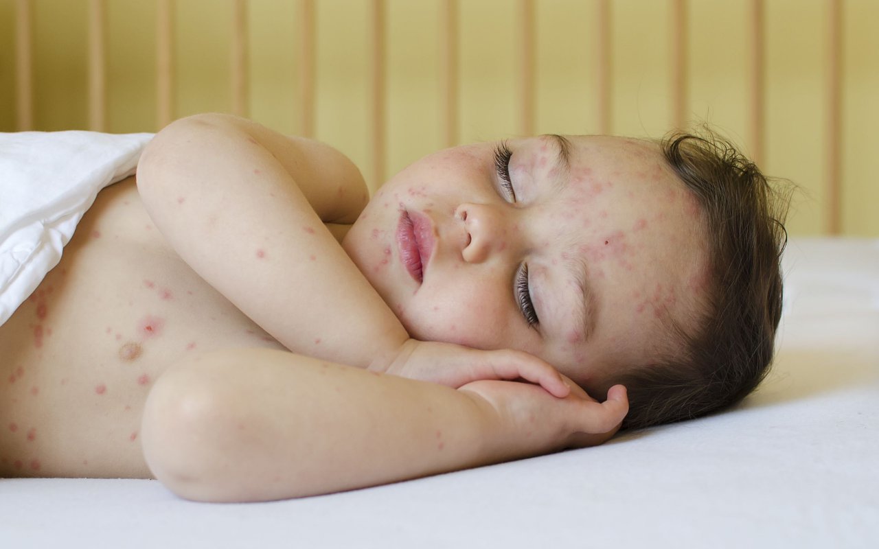 Jangan Biarkan Si Kecil Menggaruknya, Ini 7 Tips Kurangi Rasa Gatal ...