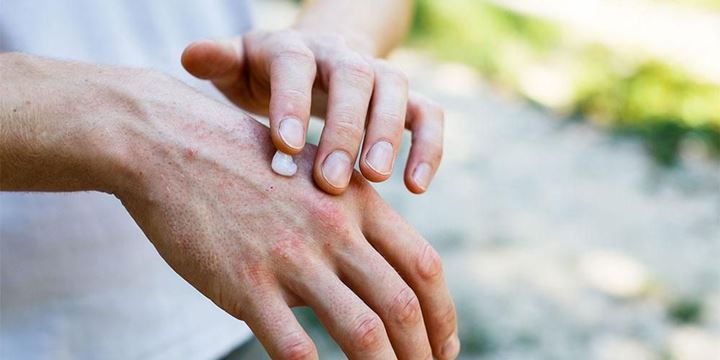 Bikin Tak Percaya Diri, Ini 7 Cara Ampuh Hilangkan Stretch Mark Putih ...