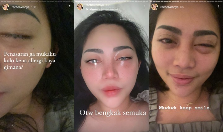 Mata Hingga Wajah Rachel Vennya Mendadak Bengkak Bikin Khawatir, Ada Apa?