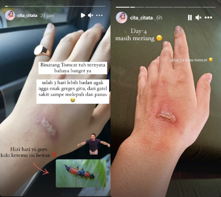 Cita Citata Ungkap Kondisi Mengkhawatirkan Usai Tangan Digigit Tomcat