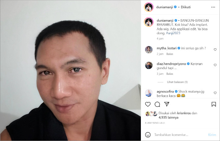 Selama Ini Botak, Penampilan Anji Dengan Rambut Bikin Publik Heboh