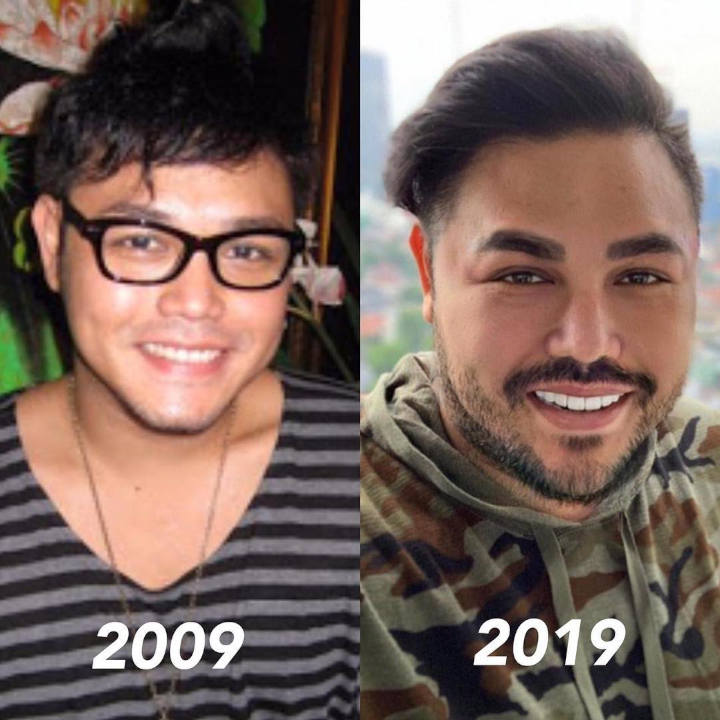 Ivan Gunawan Jalani Operasi Hidung di Turki, Intip 8 Potret Lawasnya ...