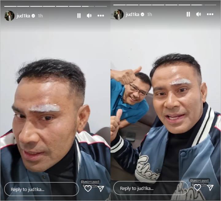 Judika Kecelakaan Kala Main Bola, Pelipis Mata Sampai Robek