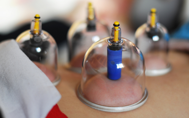 Dipakai Hingga Atlet Olimpiade, Terapi Bekam Ternyata Punya Segudang ...